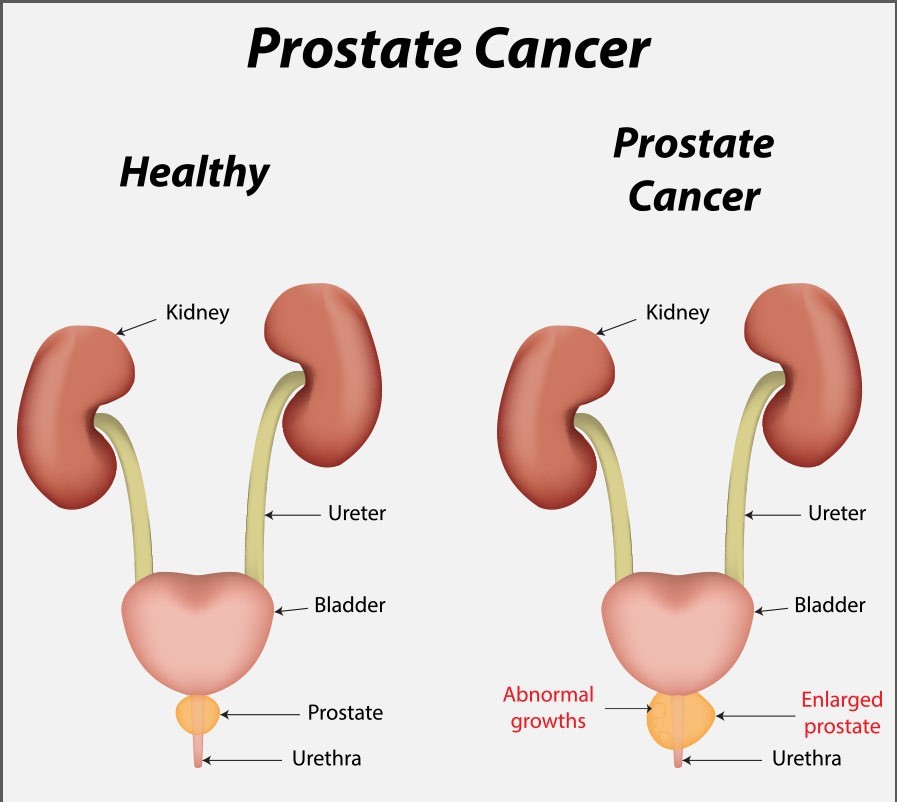Prostate cancer with its Types, Symptoms, Causes, and Treatment.